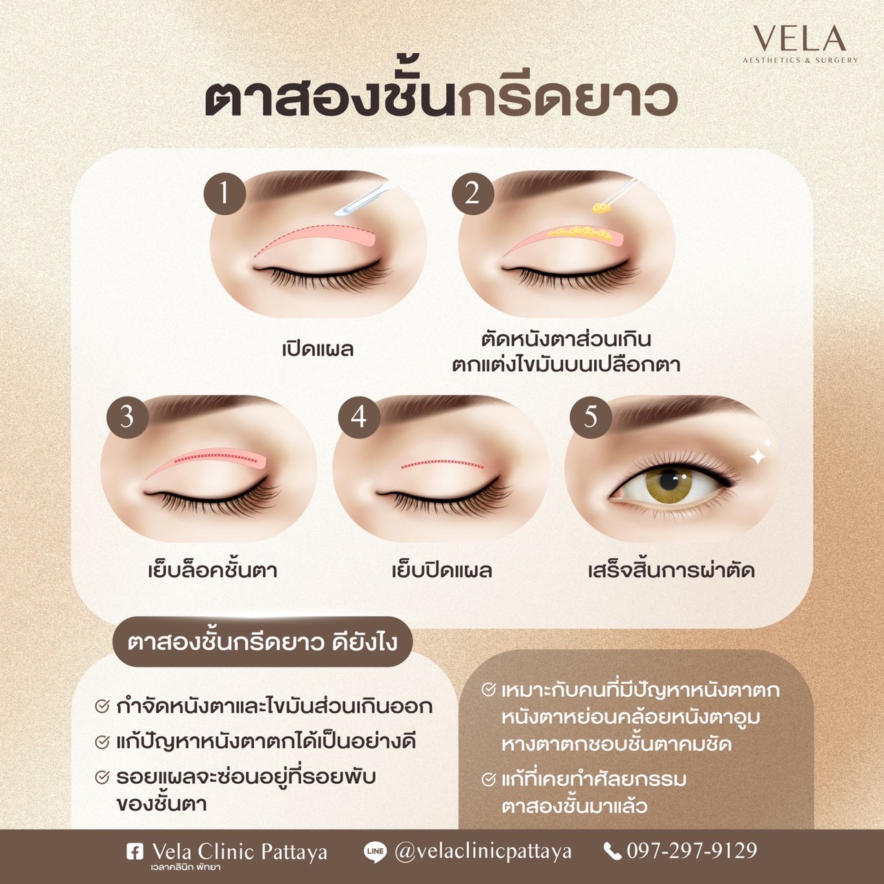 “ทำตาสองชั้น เทคนิคกรีดยาว พัทยา | Vela Clinic”